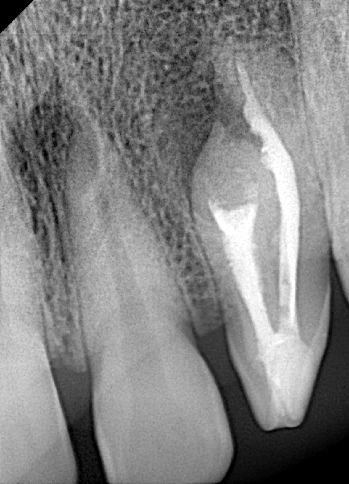 NanoPix Intraoral Digital Sensor | High-Resolution Dental Imaging with ...